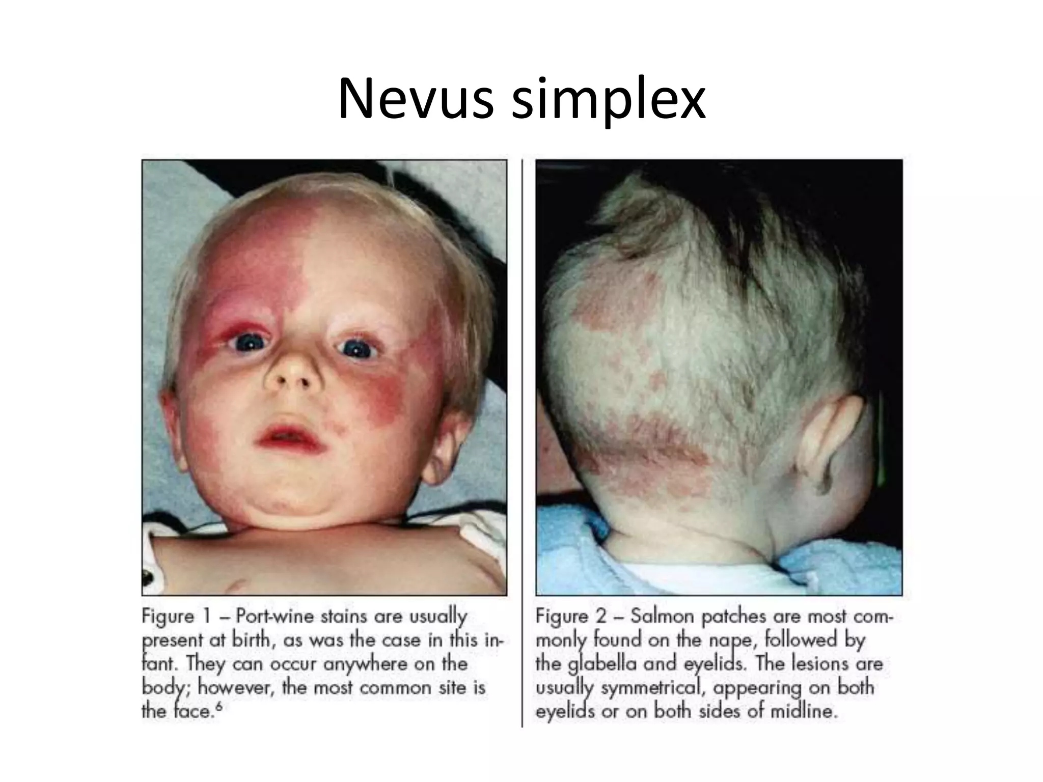 Vascular anomalies | PPTX