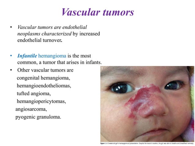 Vascular anomalies | PPTX