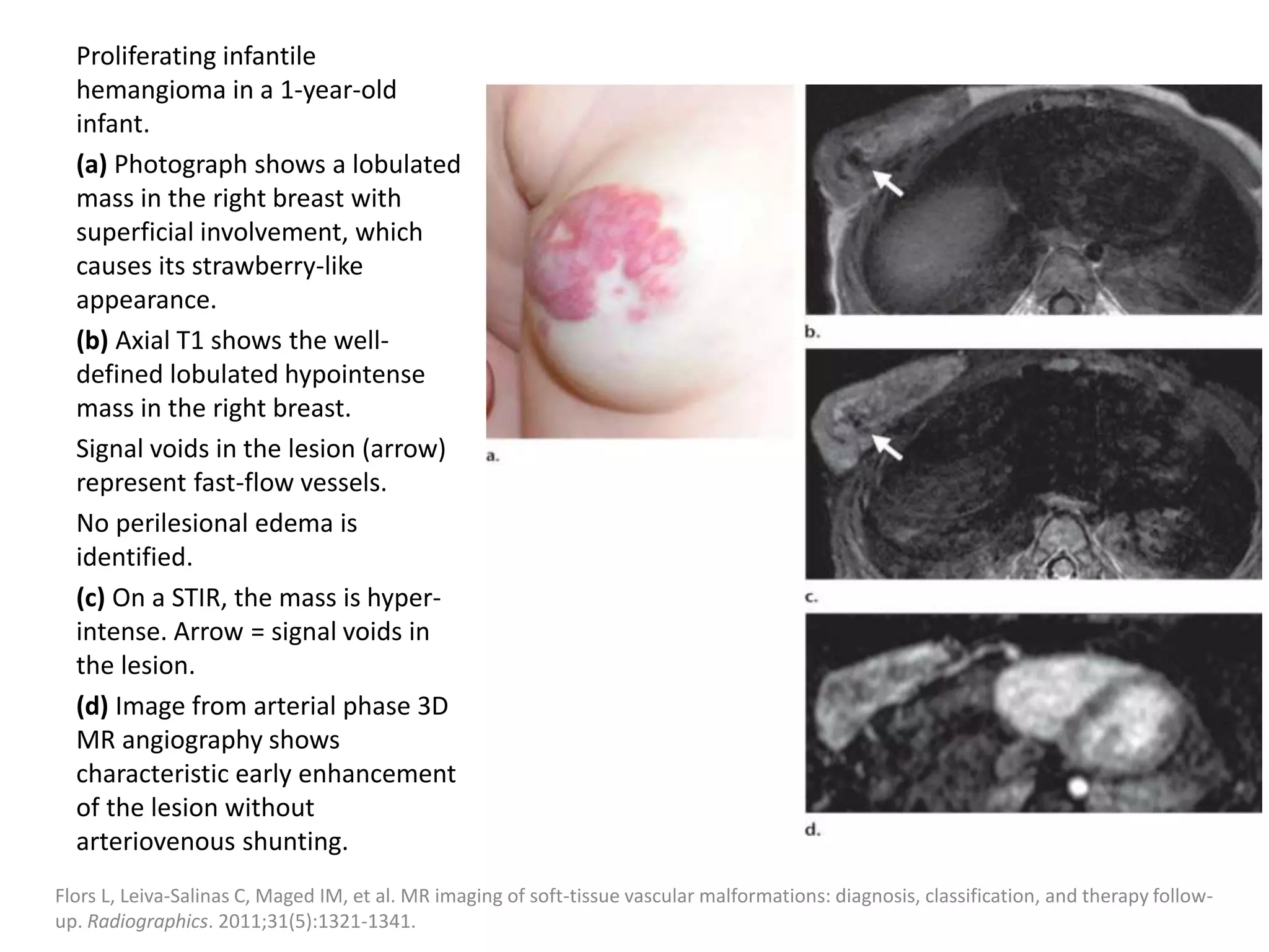 Vascular anomalies.pptx