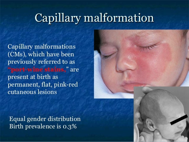 Vascular anomalies ashraf