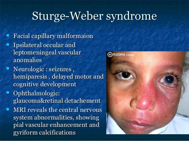 Vascular anomalies ashraf