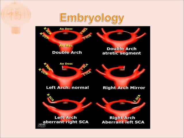 Vascular anomalies of aorta | PPT