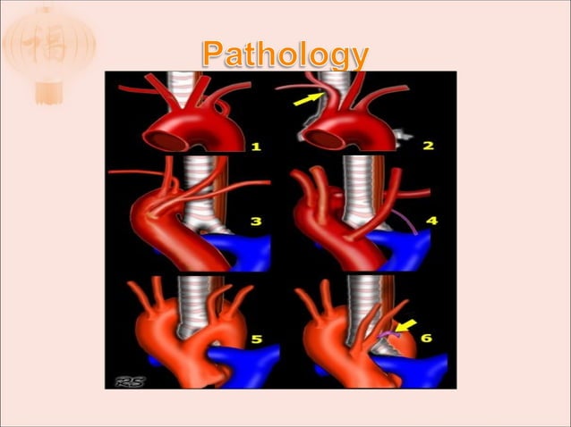 Vascular anomalies of aorta | PPT