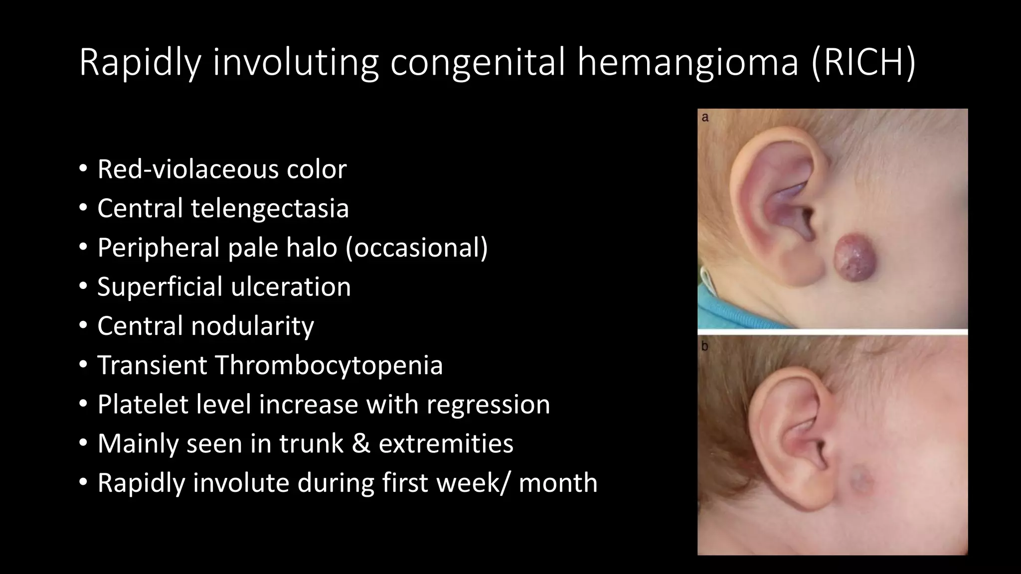 Vascular anomalies of head and neck | PPTX
