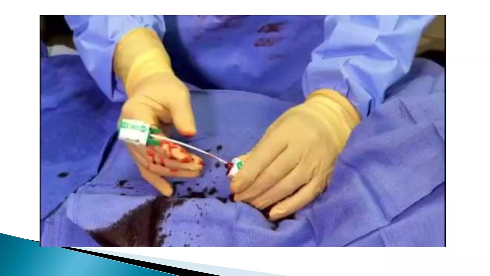 Vascular closure device.pptx