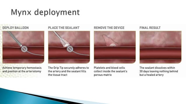 Vascular closure device.pptx | First Aid | Injuries