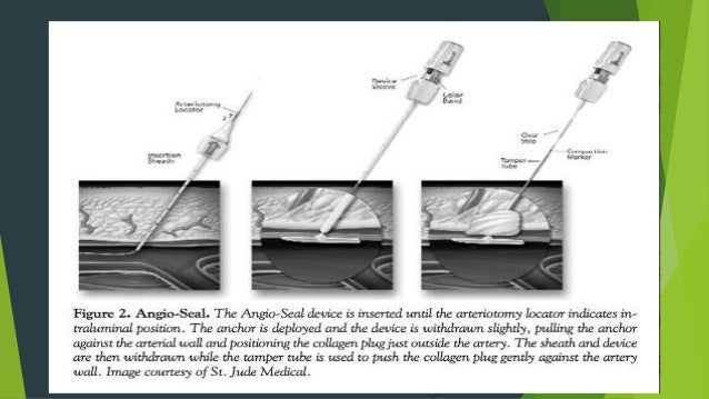 Vascular closure devices