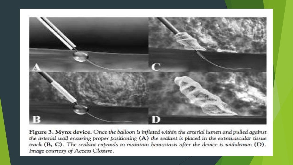 Vascular closure devices