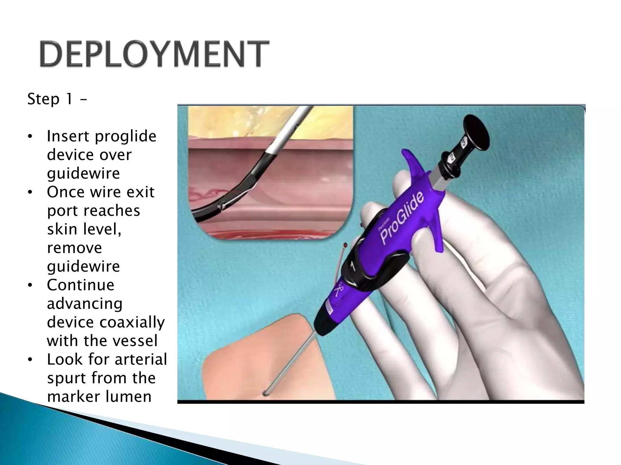 vascular closure devices II.pptx