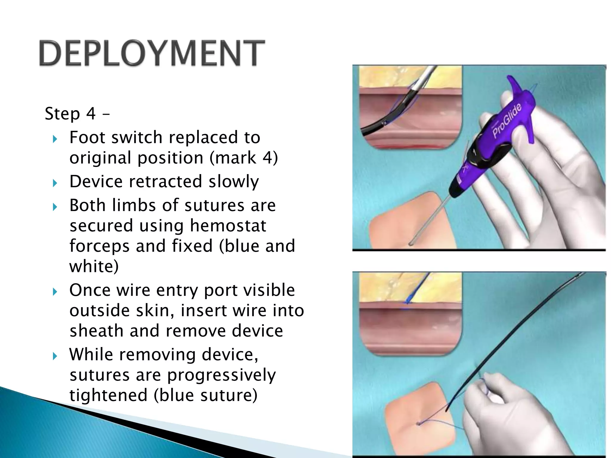 vascular closure devices II.pptx