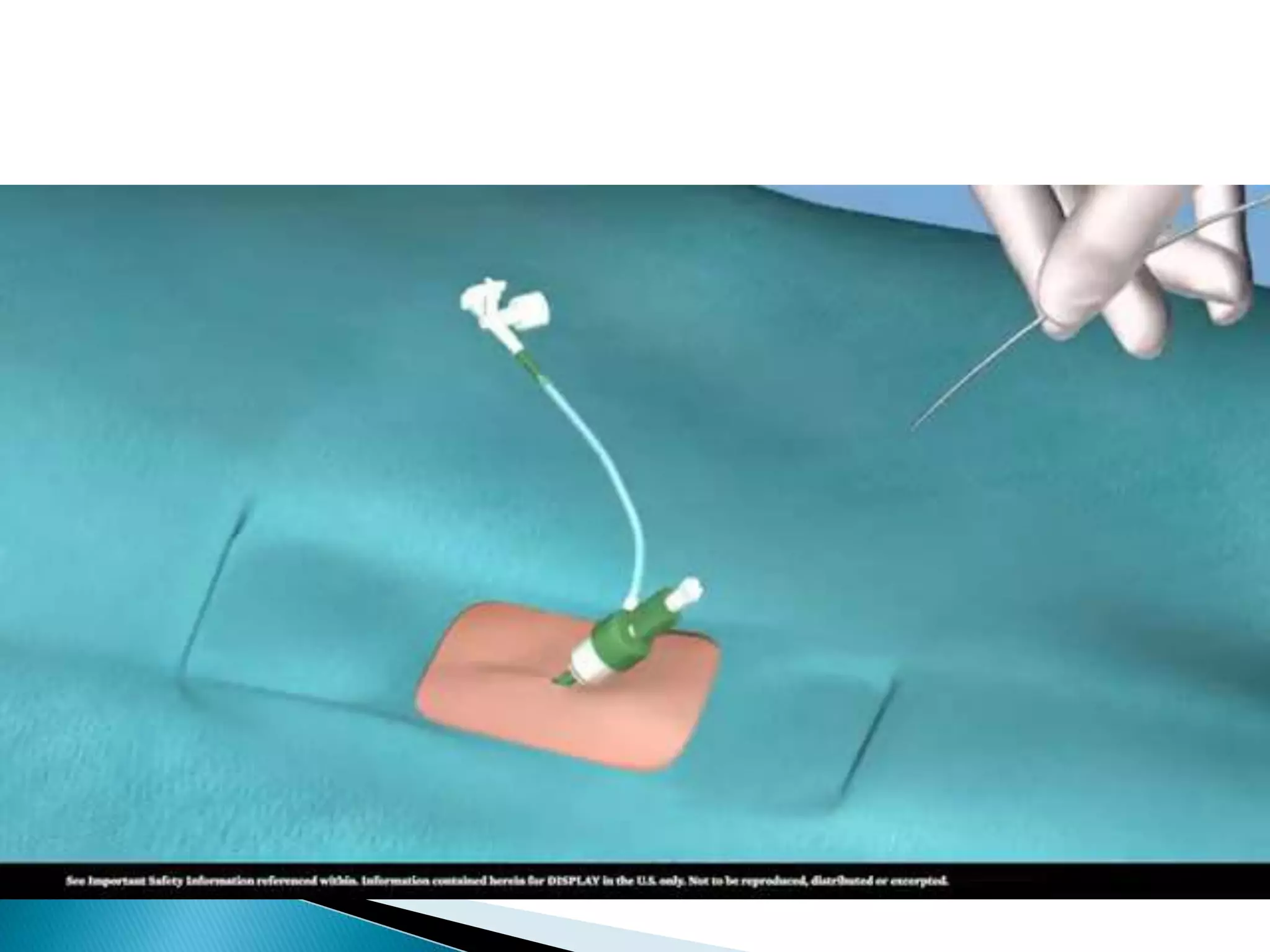 vascular closure devices II.pptx
