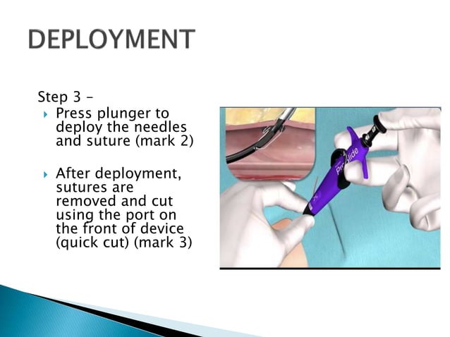 vascular closure devices II.pptx