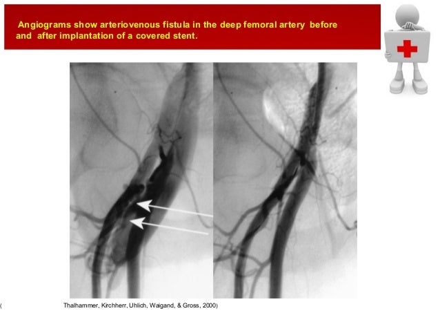 Vascular complications post cardiac catherization