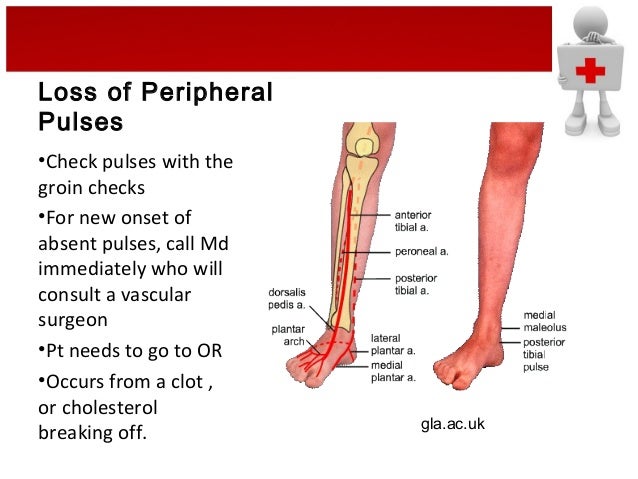 Vascular complications post cardiac catherization