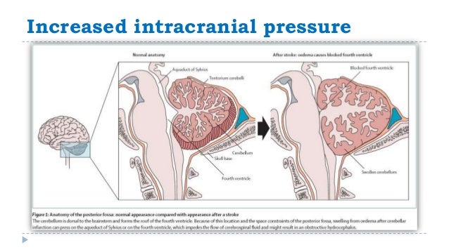 Management of Increased intracranial pressure in cerebellar stroke