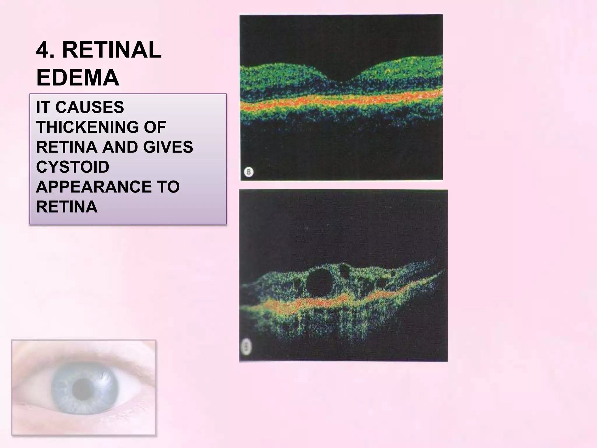 Vascular disorders of retina | PPTX