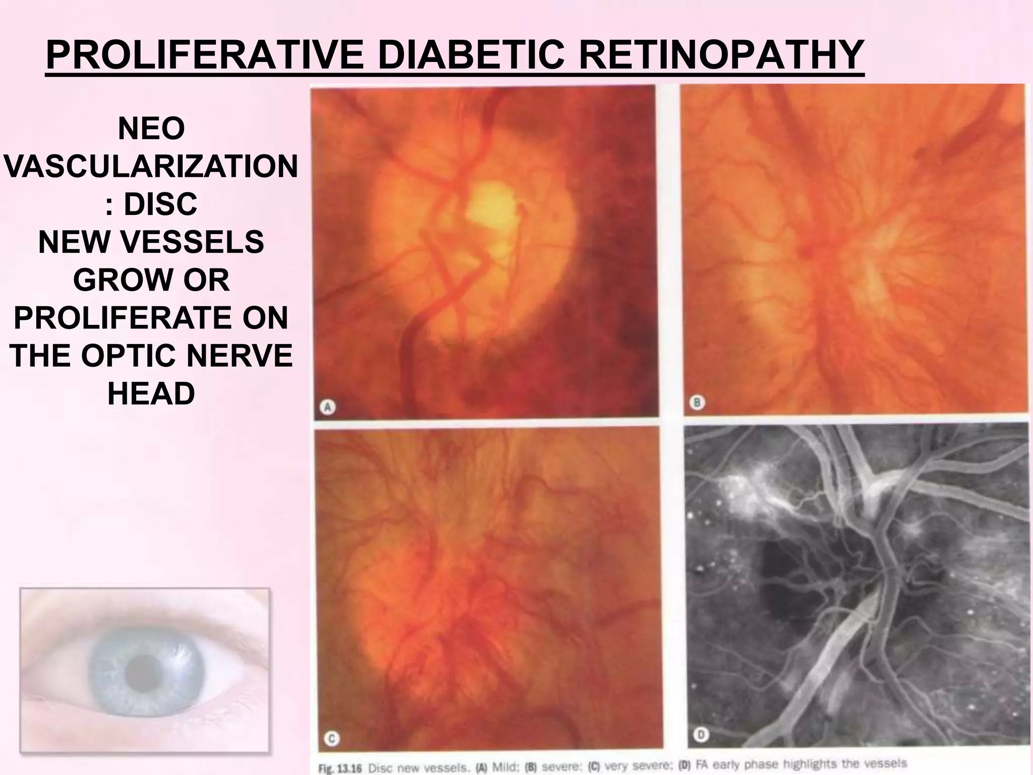 Vascular disorders of retina | PPTX