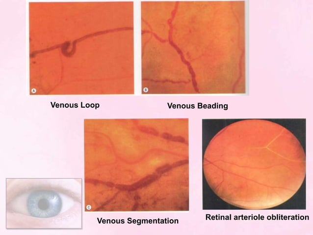 Vascular disorders of retina | PPTX