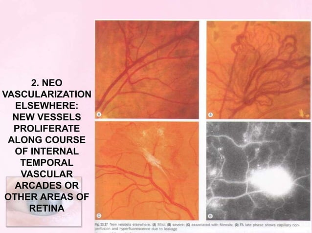 Vascular disorders of retina | PPTX