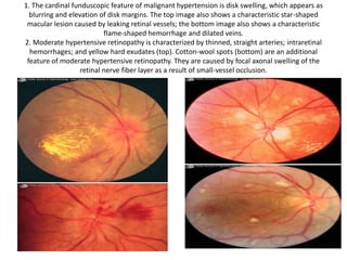 Vascular disorders of retina | PPTX