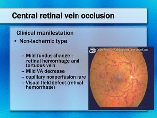 Vascular disorders of retina | PPTX