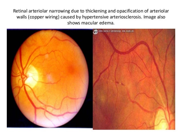 Vascular disorders of retina