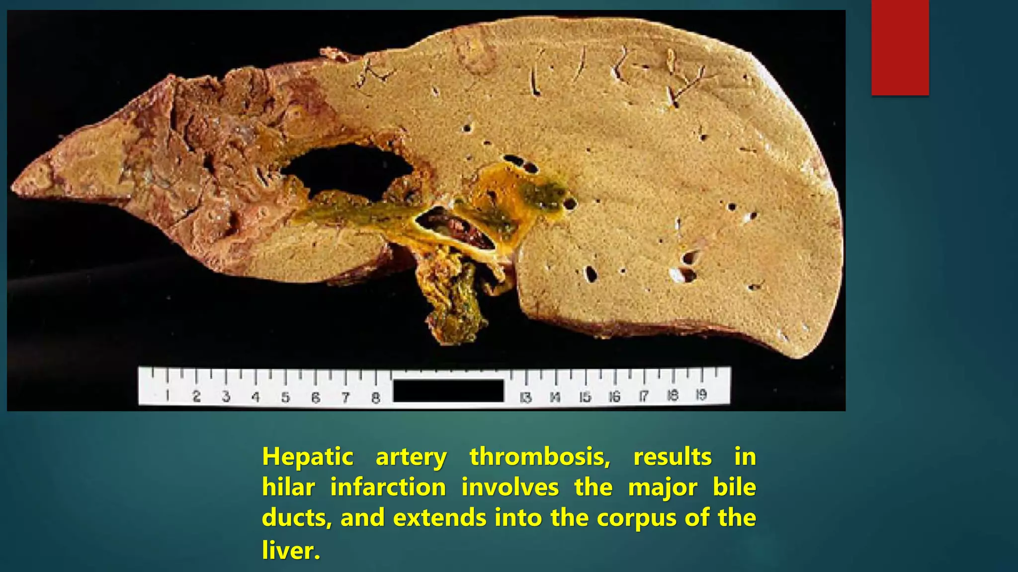 Vascular disorders of the liver | PPTX