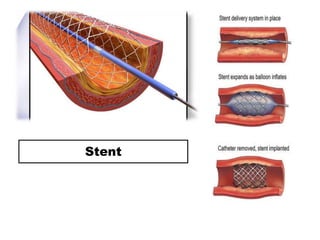 Vascular implants & grafts | PPT