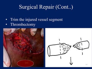 Vascular injuries and Principles of management 2021 | PPT