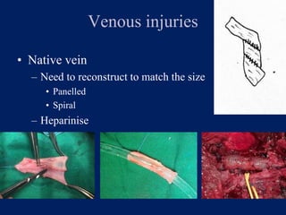 Vascular injuries and Principles of management 2021 | PPT