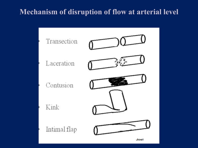 Vascular injuries and Principles of management 2021 | PPT