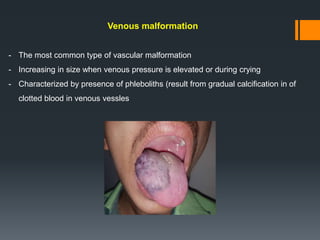 Vascular lesions in the head and neck regions | PPTX
