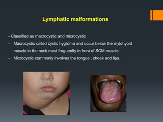 Vascular lesions in the head and neck regions | PPTX