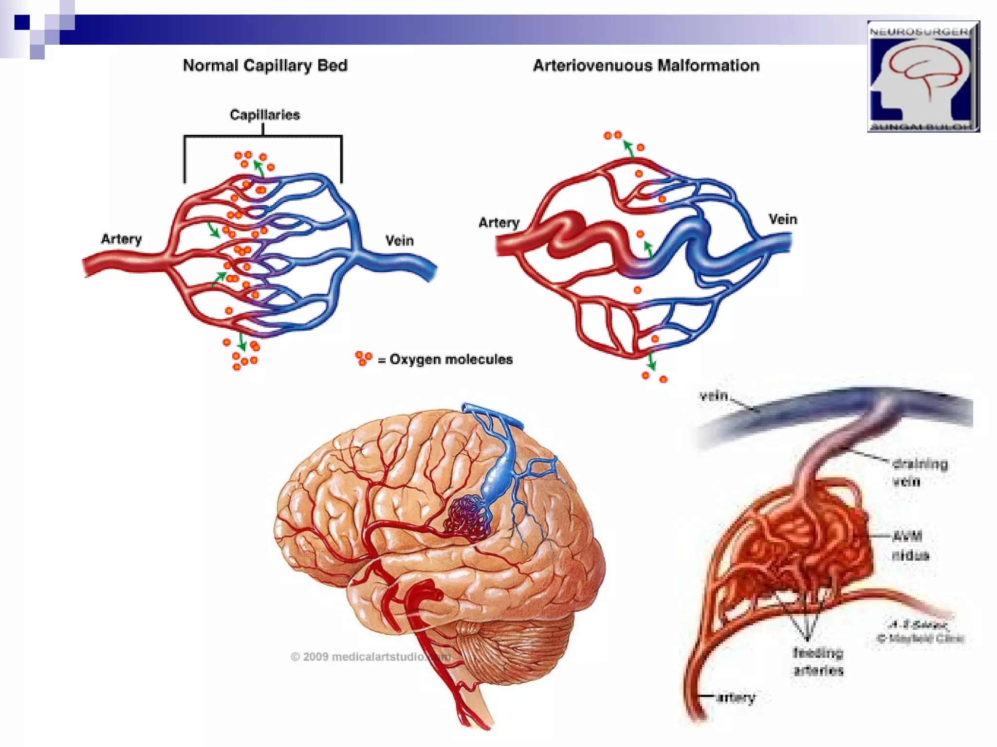Vascular Lesions of the Brain | PPT