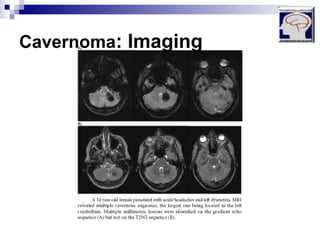Vascular Lesions of the Brain | PPT