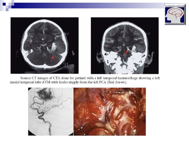 Vascular Lesions of the Brain | PPT