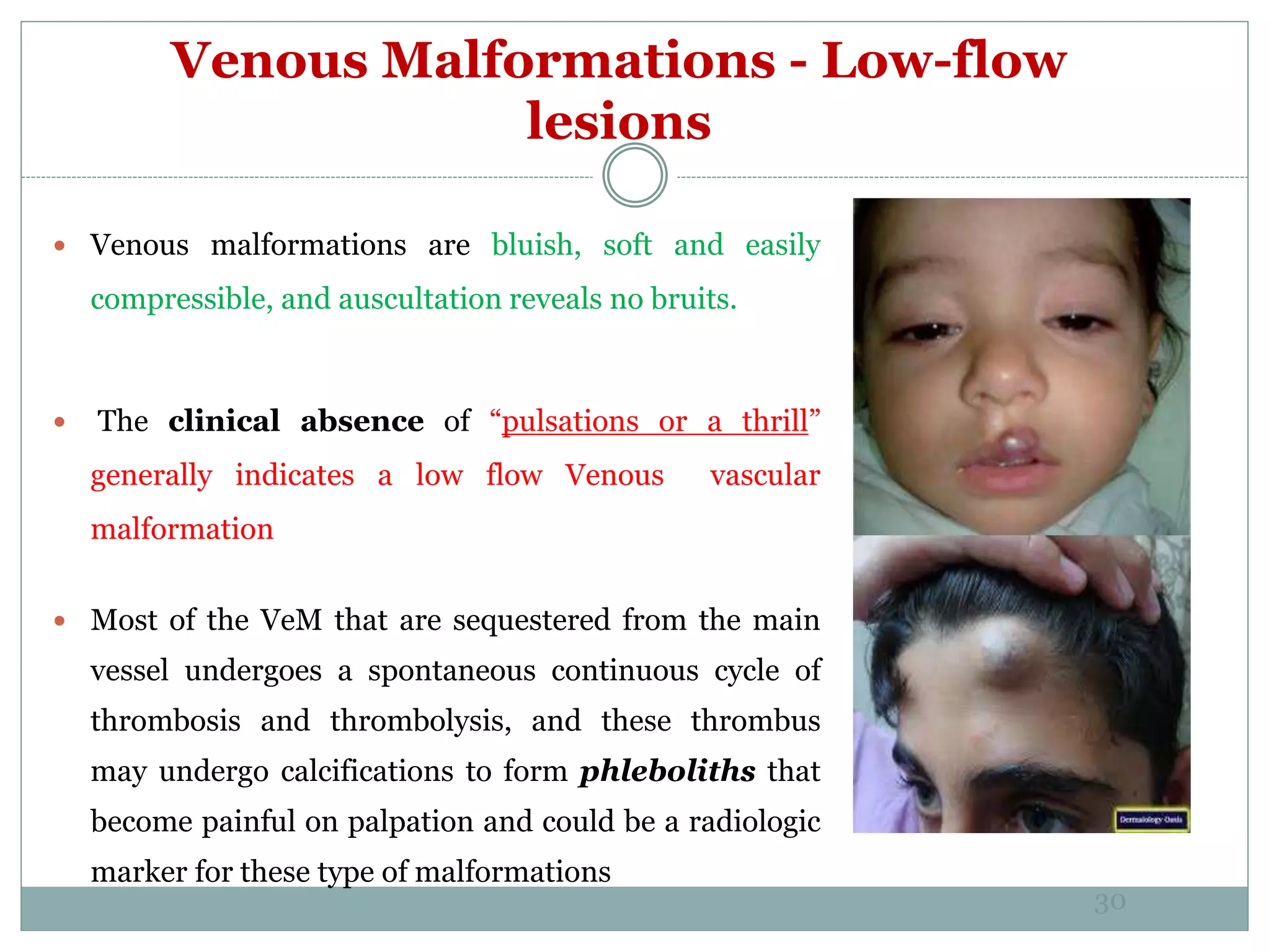 Vascular malformation | PPTX
