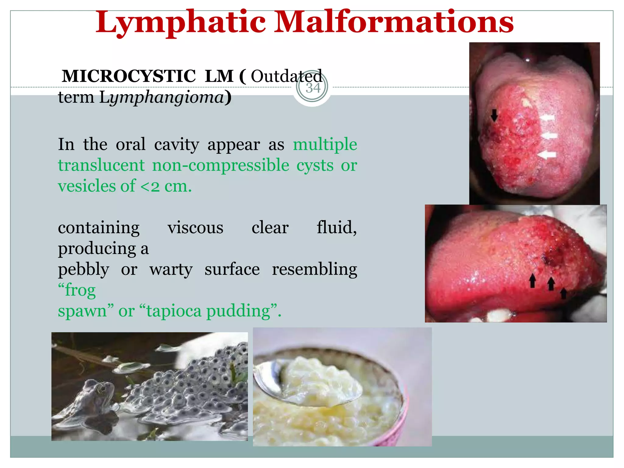 Vascular malformation | PPTX