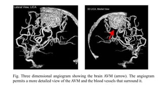 VASCULAR MALFORMATION OF BRAIN RADIOLOGY.pptx