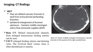 VASCULAR MALFORMATION OF BRAIN RADIOLOGY.pptx
