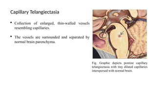 VASCULAR MALFORMATION OF BRAIN RADIOLOGY.pptx