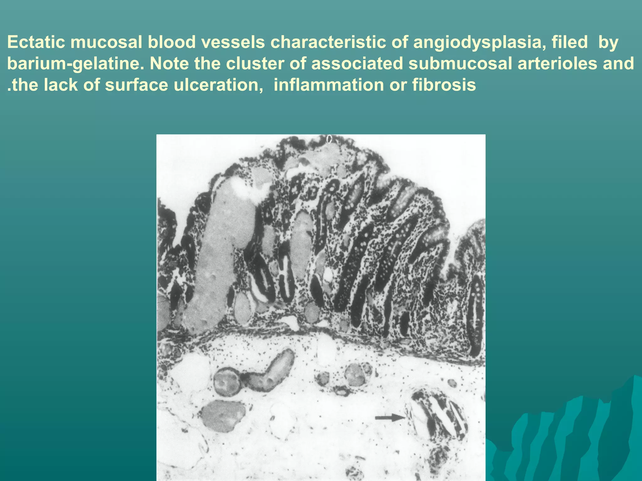 Vascular malformation of the gastrointestinal tract | PPT