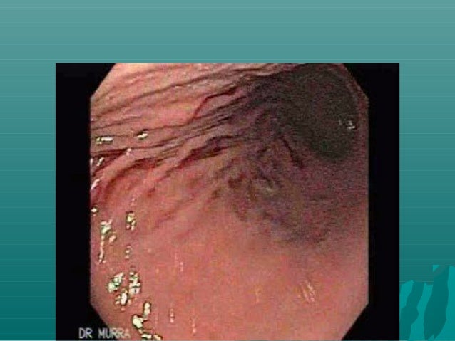 Vascular malformation of the gastrointestinal tract