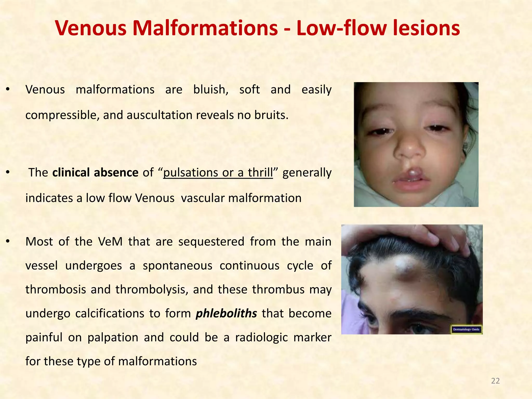 Vascular malformations | PPTX