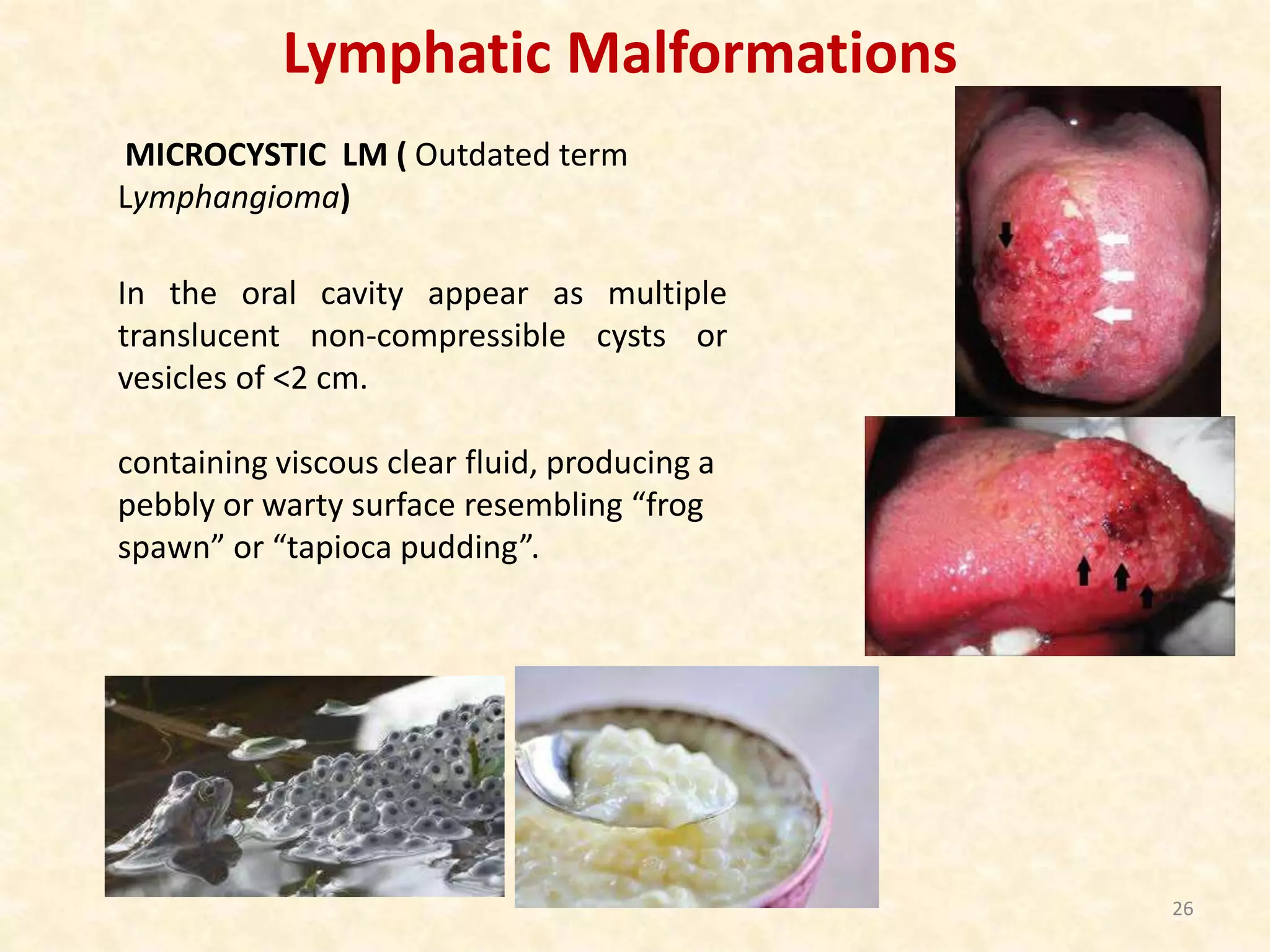 Vascular malformations | PPTX