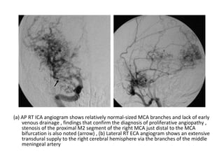 Diagnostic Imaging of Intracranial Vascular malformations | PPT