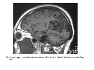 Diagnostic Imaging of Intracranial Vascular malformations | PPT