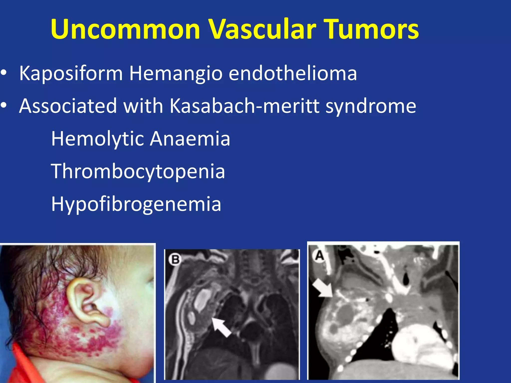 Vascular Anomalies: Vascular Tumours and Vascular malformations | PPTX
