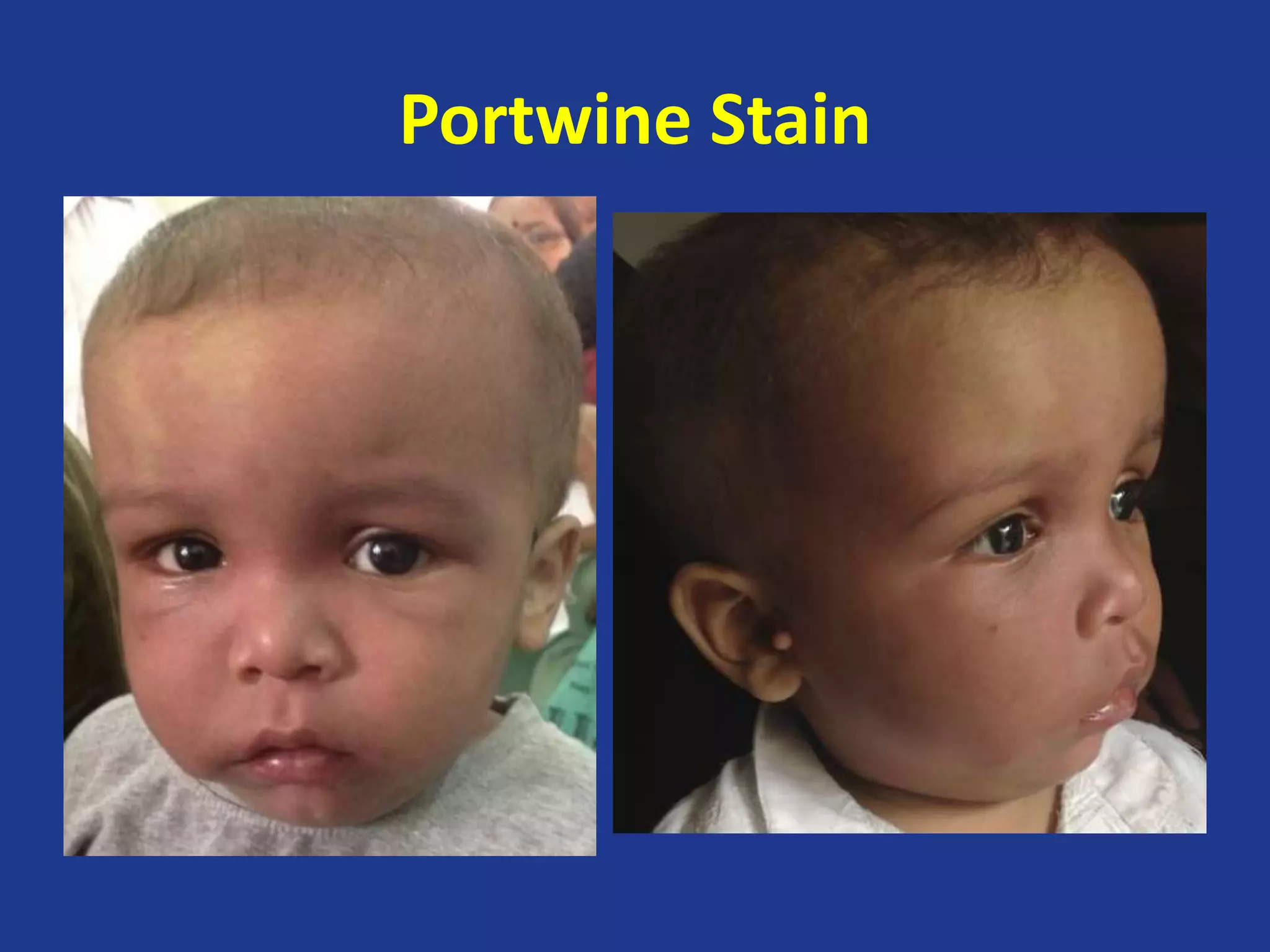 Vascular Anomalies: Vascular Tumours and Vascular malformations | PPTX