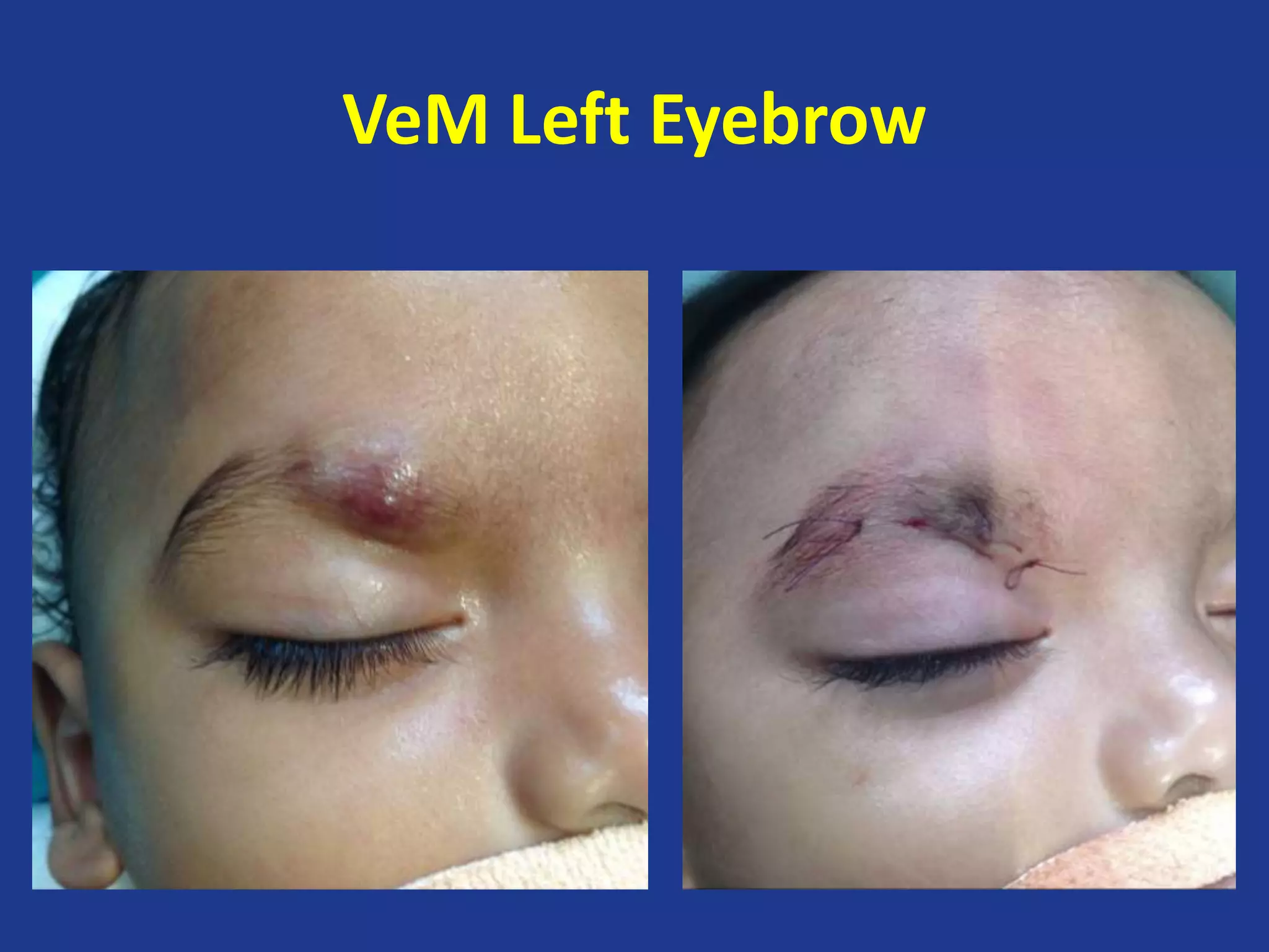 Vascular Anomalies: Vascular Tumours and Vascular malformations | PPTX